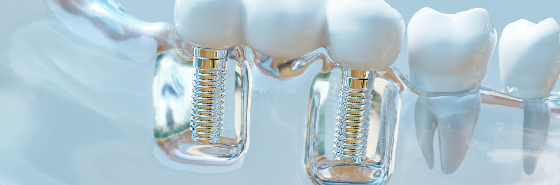 Dental Implant FAQs | Tooth Stories