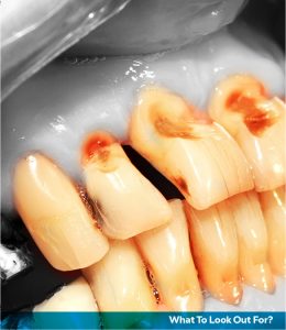 Toothbrush Abrasion | Tooth Stories