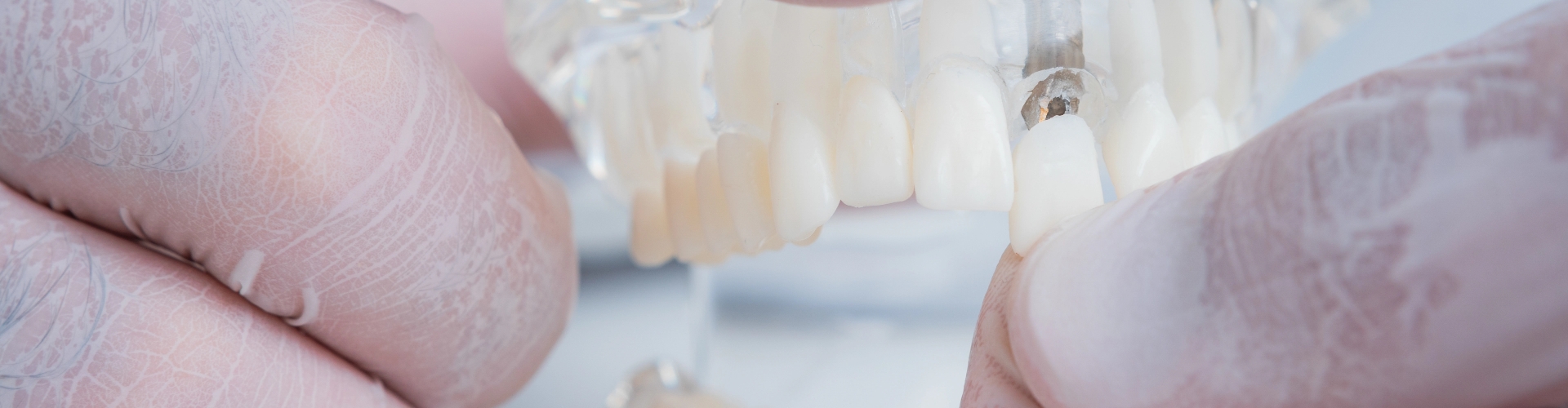 Quick Tooth Replacement Solutions | Tooth Stories